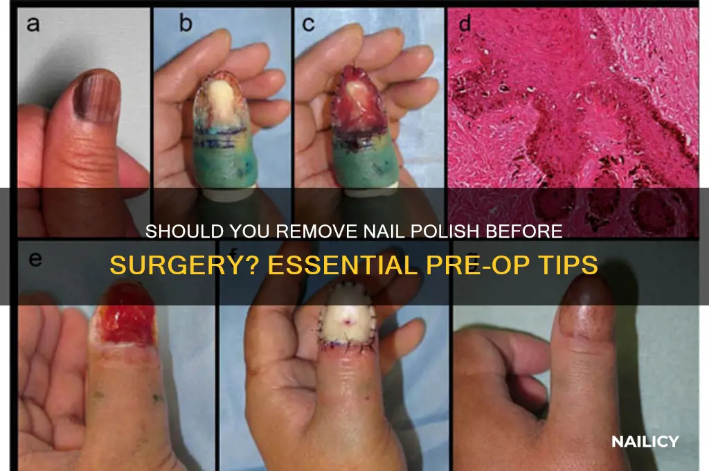 Should You Remove Nail Polish Before Surgery? Essential Pre-Op Tips ...