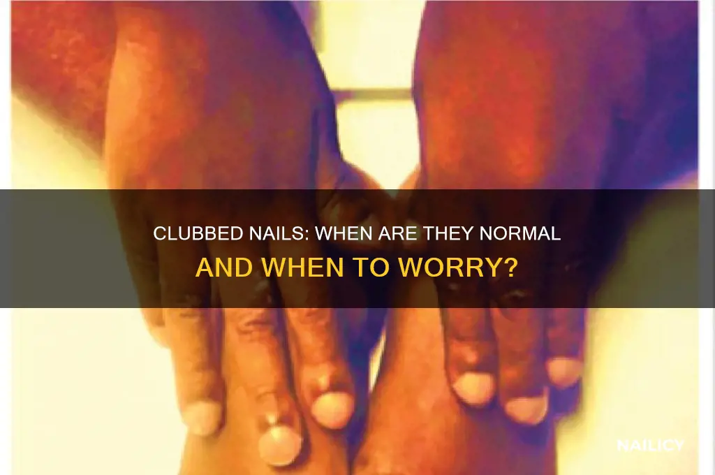 Clubbed Nails: When Are They Normal And When To Worry? | Nailicy