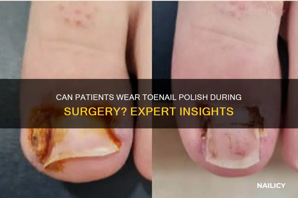Can Patients Wear Toenail Polish During Surgery? Expert Insights | Nailicy