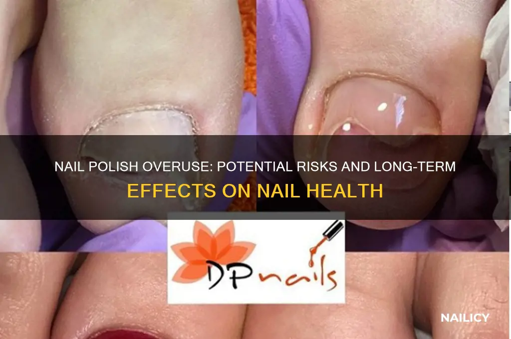 Nail Polish Overuse: Potential Risks And Long-Term Effects On Nail ...