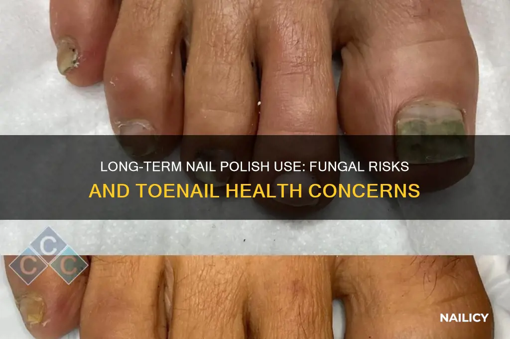 Long-Term Nail Polish Use: Fungal Risks And Toenail Health Concerns ...