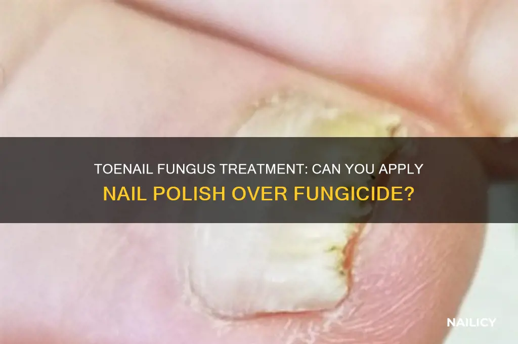 Toenail Fungus Treatment: Can You Apply Nail Polish Over Fungicide ...