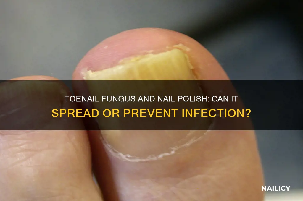 Toenail Fungus And Nail Polish: Can It Spread Or Prevent Infection ...