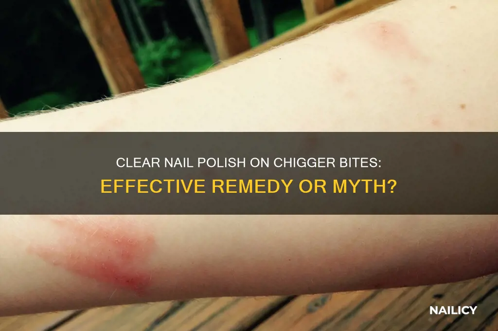 What To Put On Chigger Bites