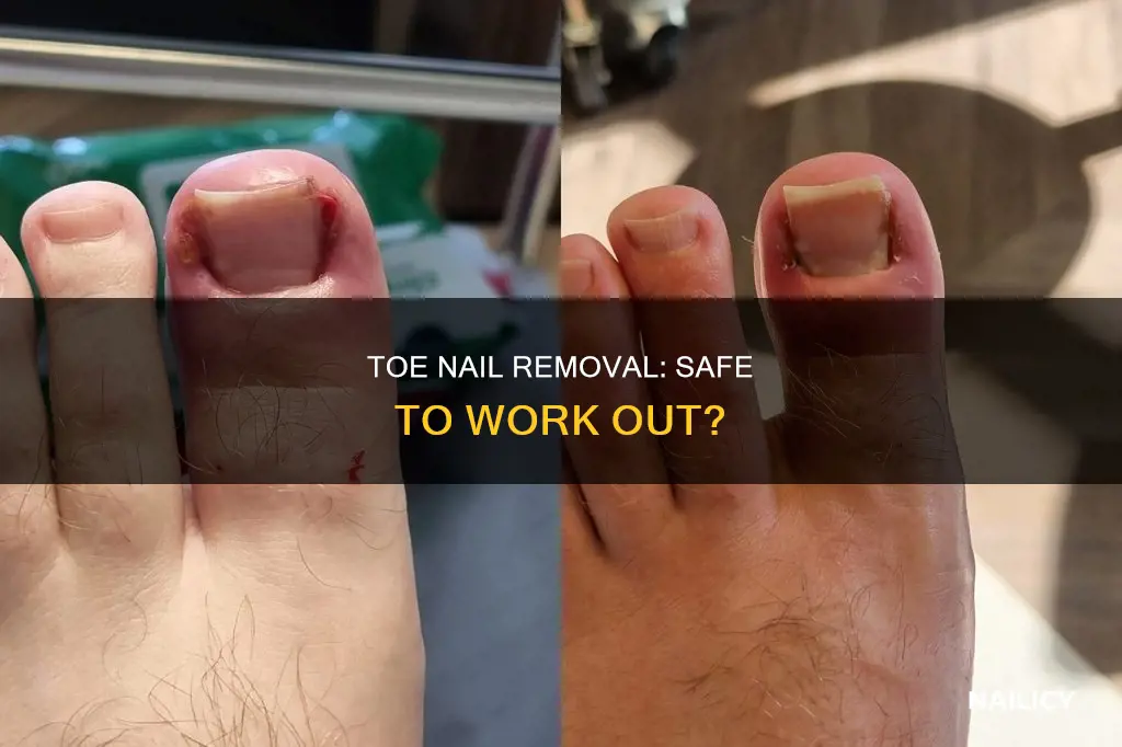 Toe Nail Removal: Safe To Work Out? | Nailicy