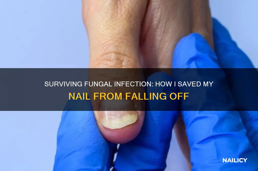 Surviving Fungal Infection: How I Saved My Nail From Falling Off | Nailicy