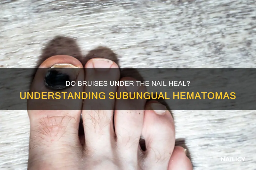 Do Bruises Under The Nail Heal? Understanding Subungual Hematomas | Nailicy