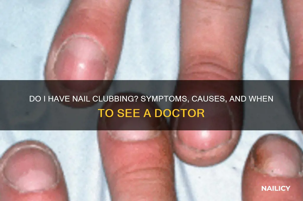 Do I Have Nail Clubbing? Symptoms, Causes, And When To See A Doctor ...