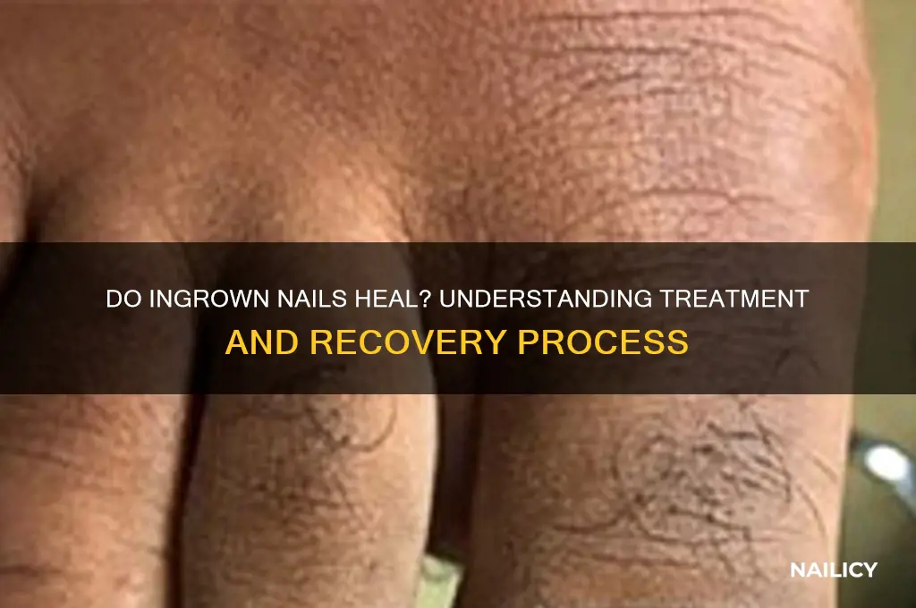 Do Ingrown Nails Heal? Understanding Treatment And Recovery Process ...