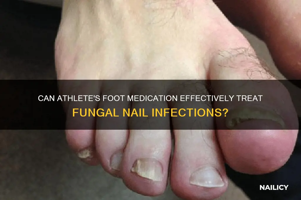 Can Athlete's Foot Medication Effectively Treat Fungal Nail Infections ...