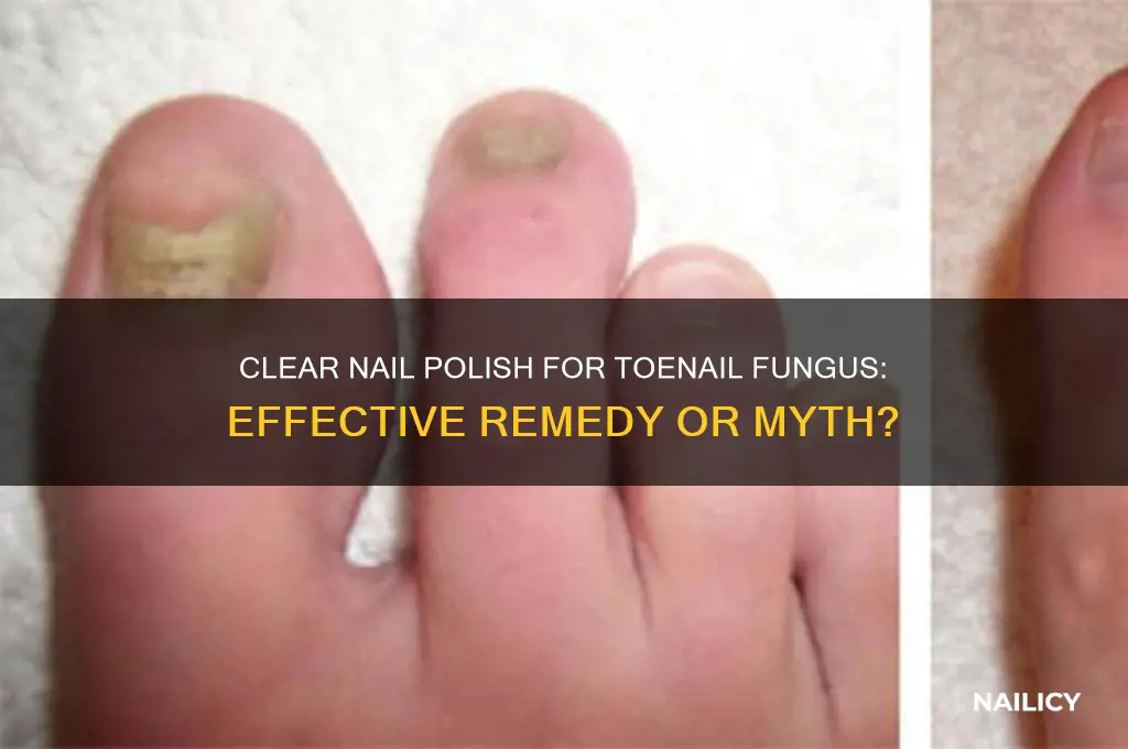 Clear Nail Polish For Toenail Fungus: Effective Remedy Or Myth? | Nailicy