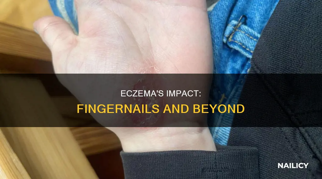 Eczema's Impact: Fingernails And Beyond | Nailicy