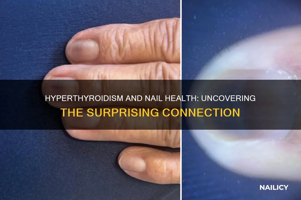 Hyperthyroidism And Nail Health: Uncovering The Surprising Connection ...