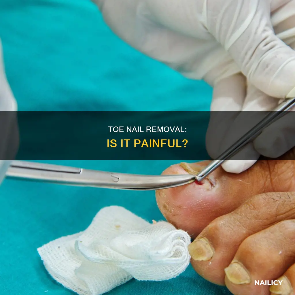 Toe Nail Removal: Is It Painful? | Nailicy