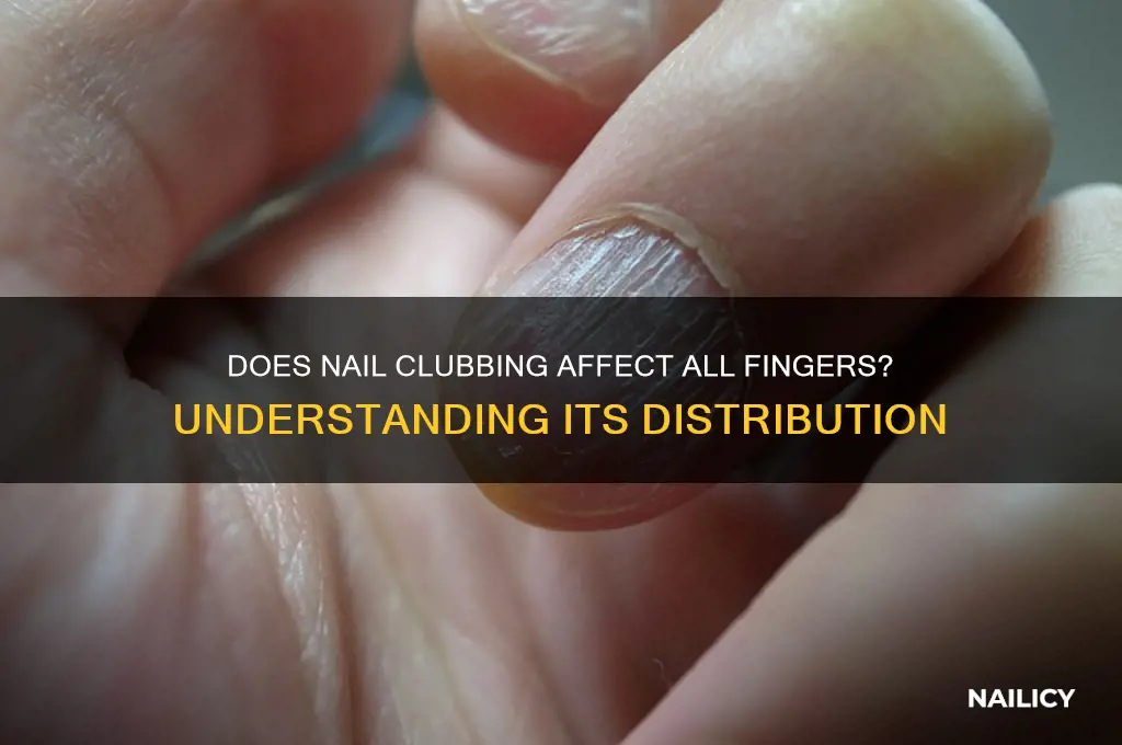 Does Nail Clubbing Affect All Fingers? Understanding Its Distribution ...