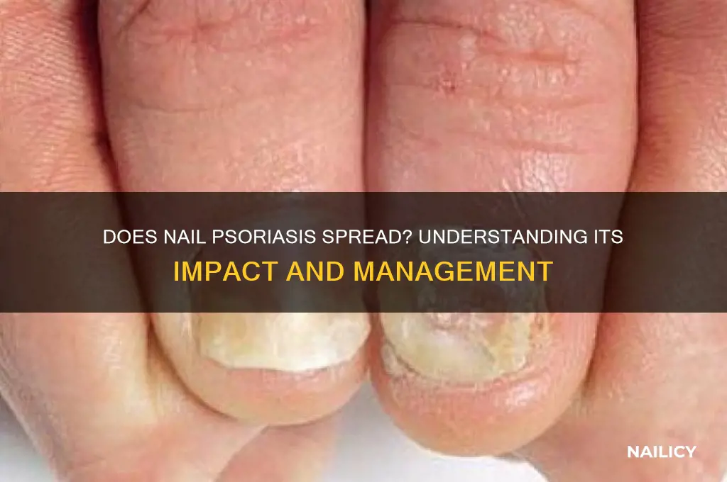 Does Nail Psoriasis Spread? Understanding Its Impact And Management ...