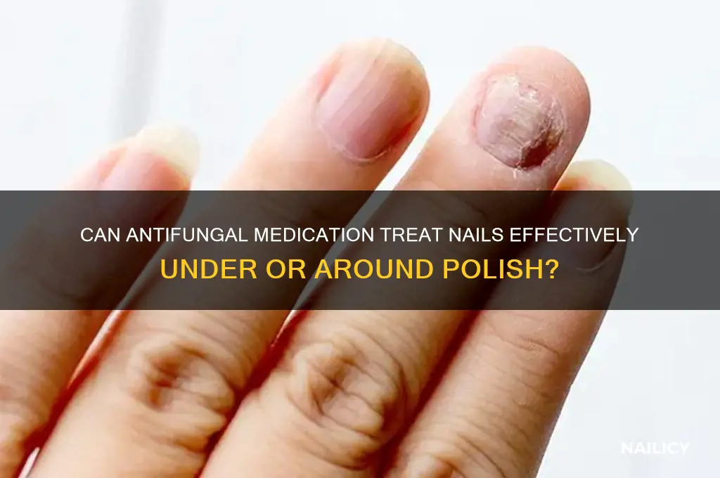 Can Antifungal Medication Treat Nails Effectively Under Or Around ...