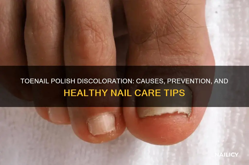 Toenail Polish Discoloration: Causes, Prevention, And Healthy Nail Care ...