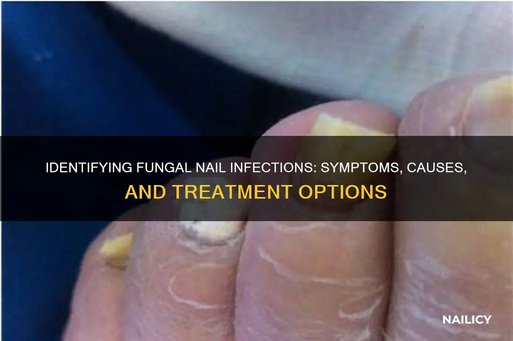Identifying Fungal Nail Infections: Symptoms, Causes, And Treatment ...