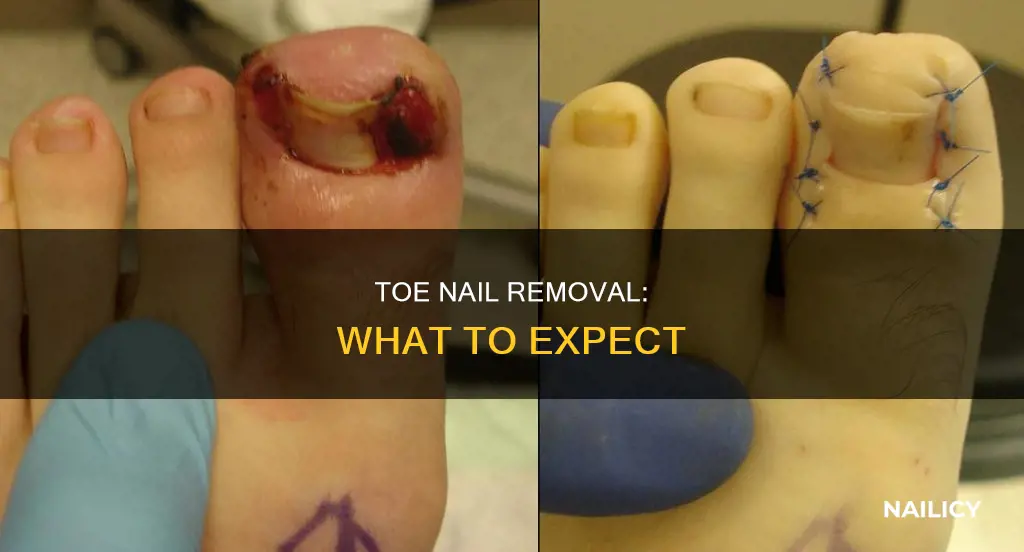 Toe Nail Removal: What To Expect | Nailicy