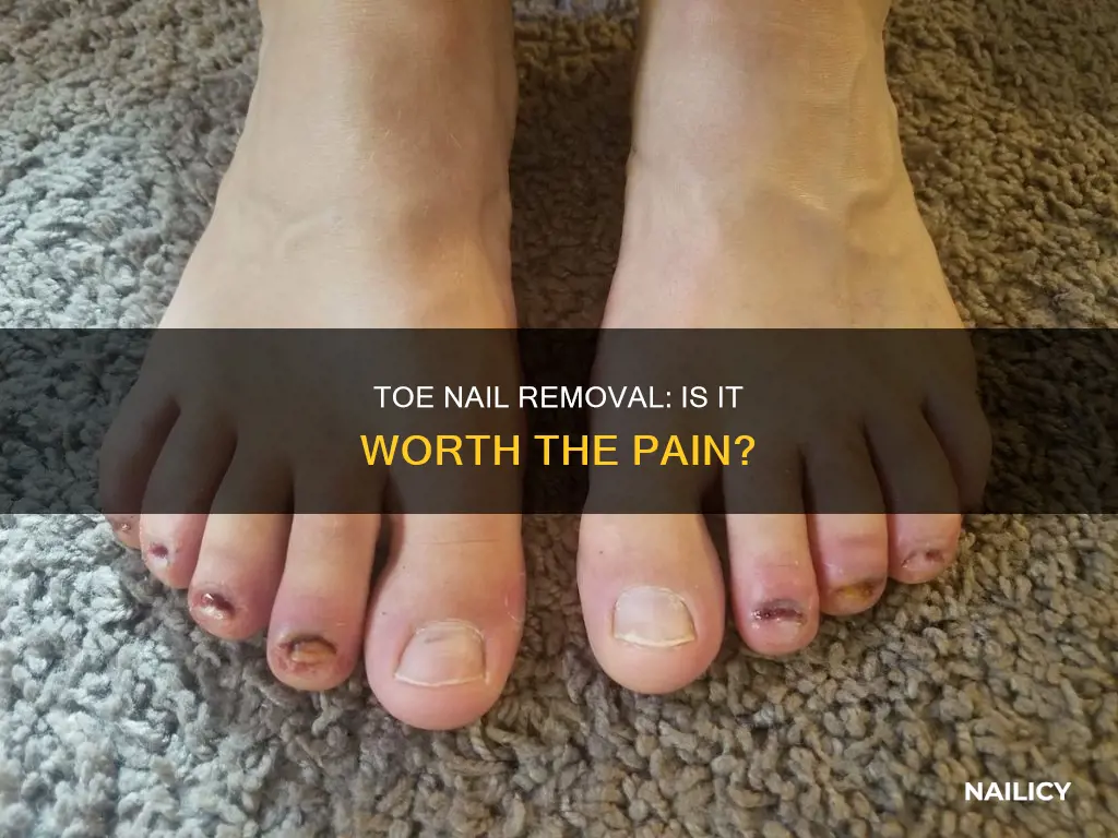 Toe Nail Removal: Is It Worth The Pain? | Nailicy