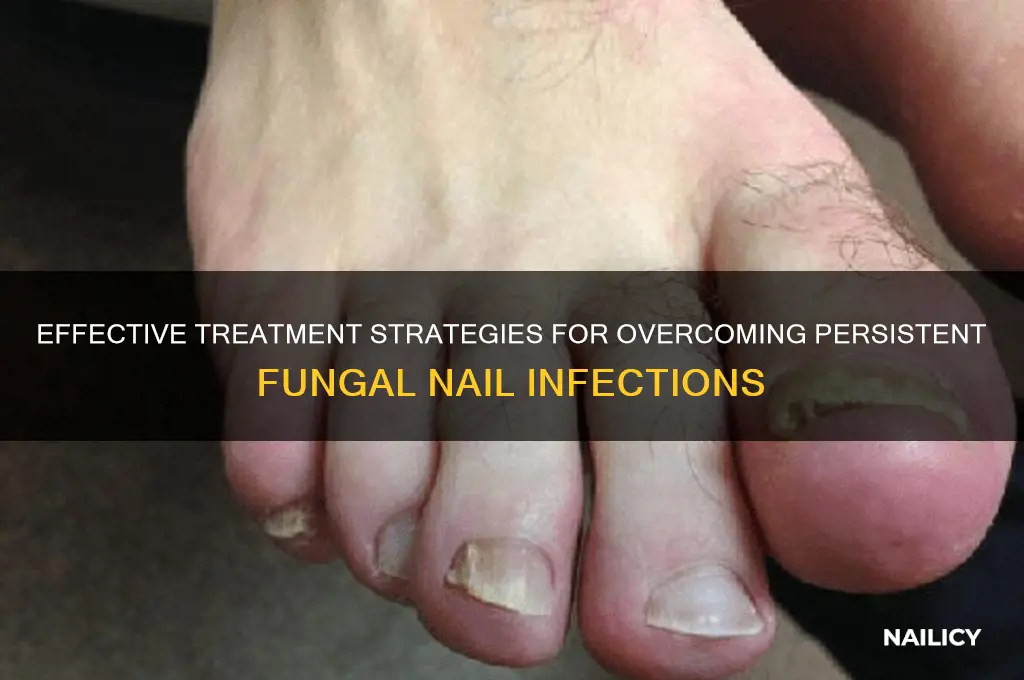 Effective Treatment Strategies For Overcoming Persistent Fungal Nail ...