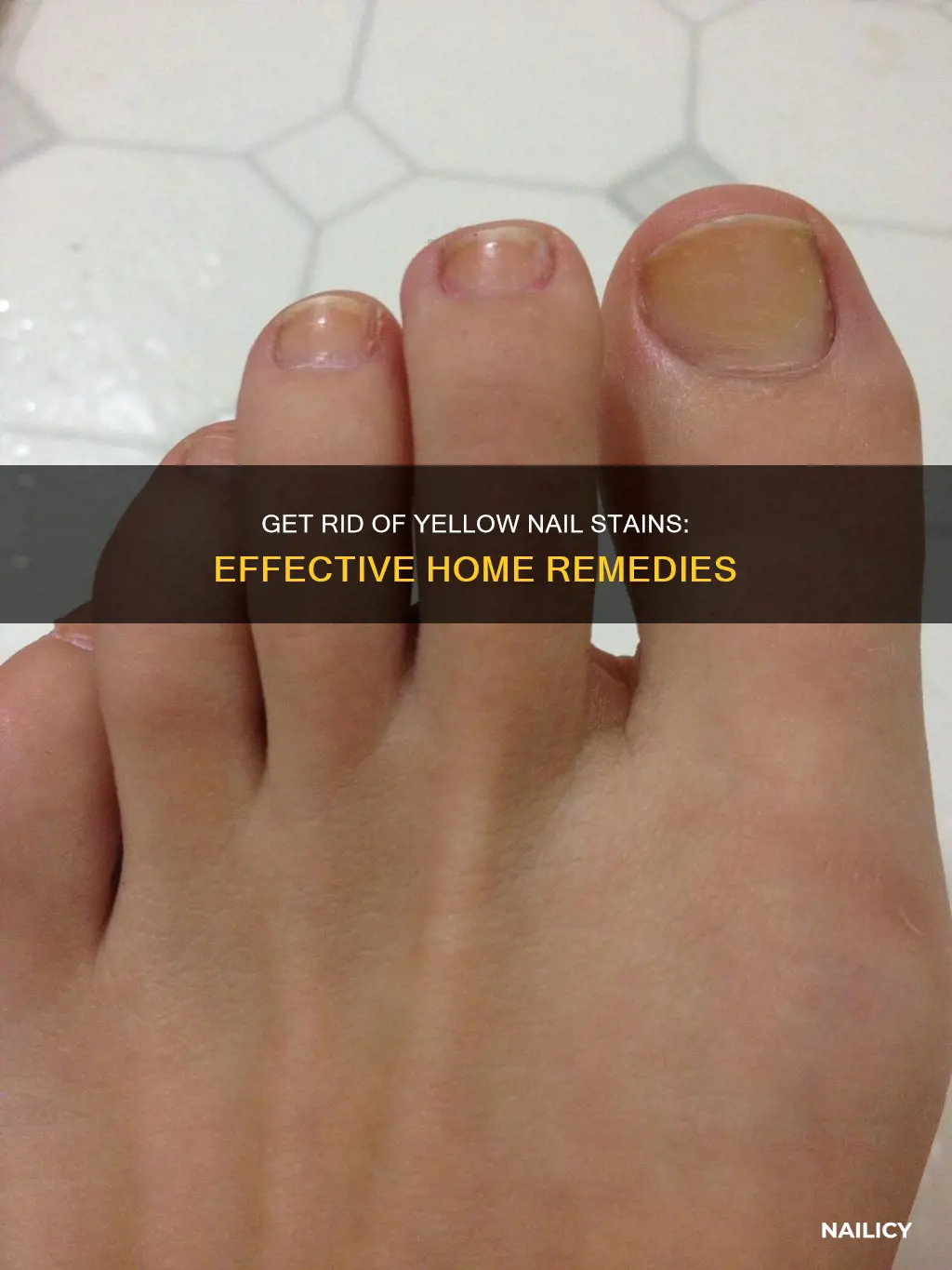 Get Rid Of Yellow Nail Stains: Effective Home Remedies | Nailicy
