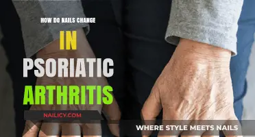 Psoriatic Arthritis And Nail Changes: Understanding Symptoms And ...