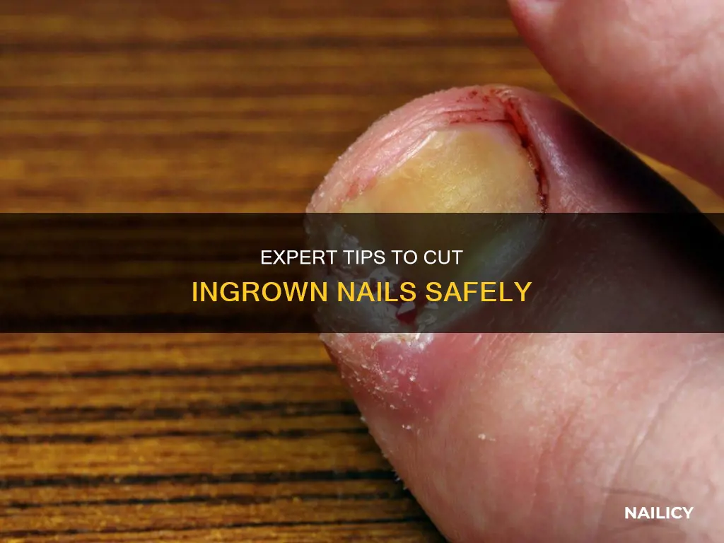 Expert Tips To Cut Ingrown Nails Safely | Nailicy