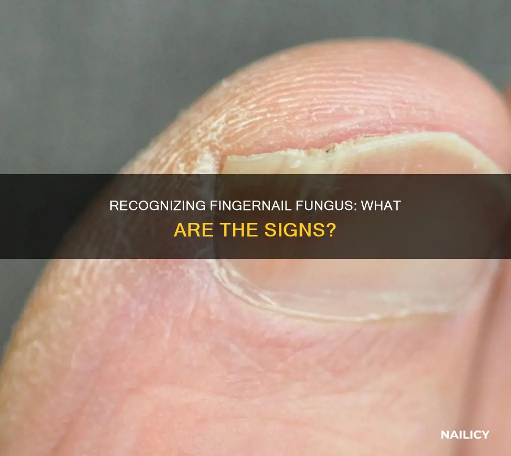 Recognizing Fingernail Fungus: What Are The Signs? | Nailicy