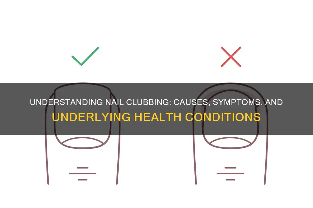 Understanding Nail Clubbing: Causes, Symptoms, And Underlying Health ...