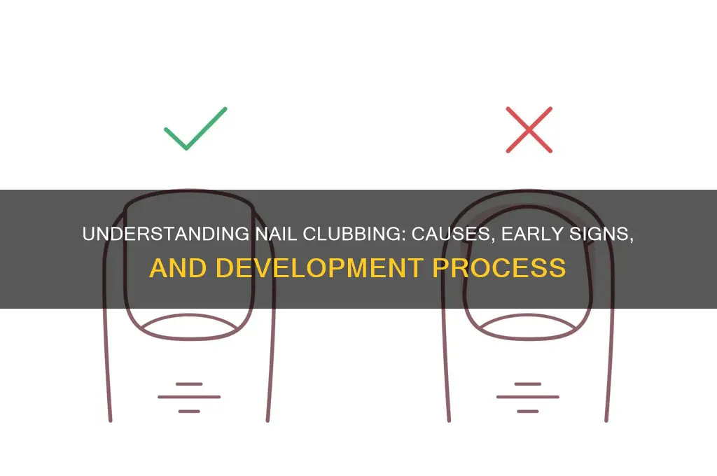 Understanding Nail Clubbing: Causes, Early Signs, And Development ...
