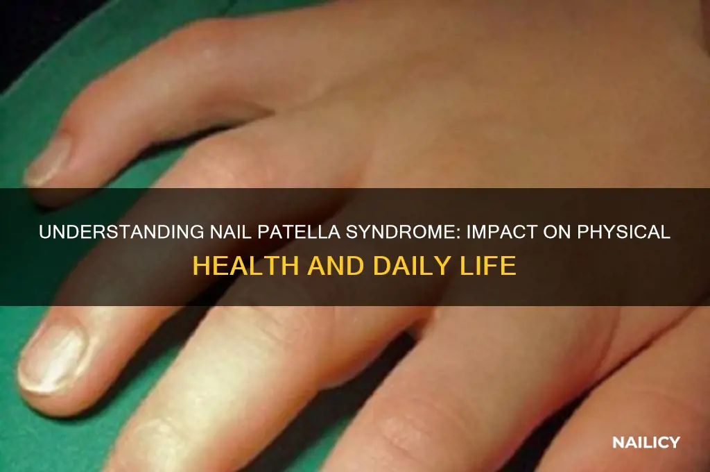 Understanding Nail Patella Syndrome: Impact On Physical Health And ...