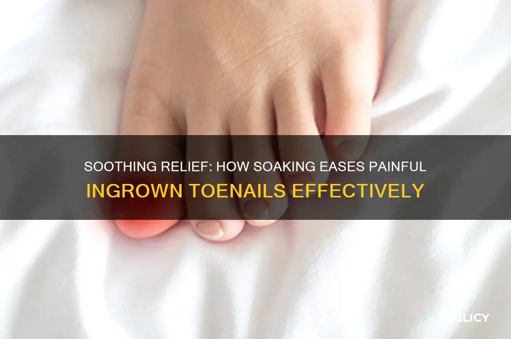 Soothing Relief: How Soaking Eases Painful Ingrown Toenails Effectively ...