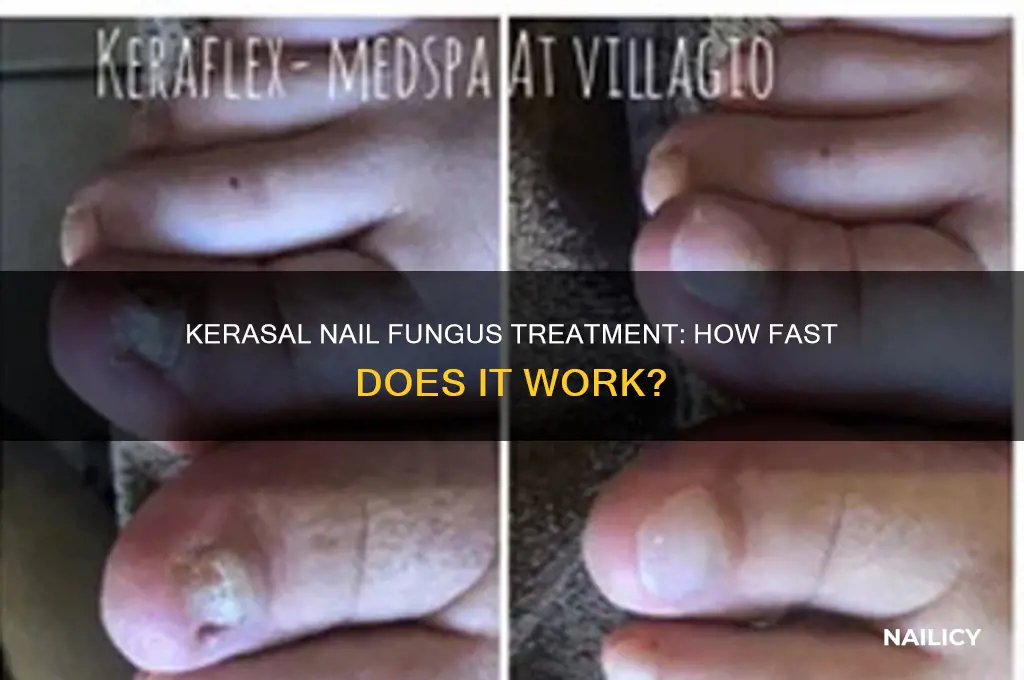Kerasal Nail Fungus Treatment: How Fast Does It Work? | Nailicy