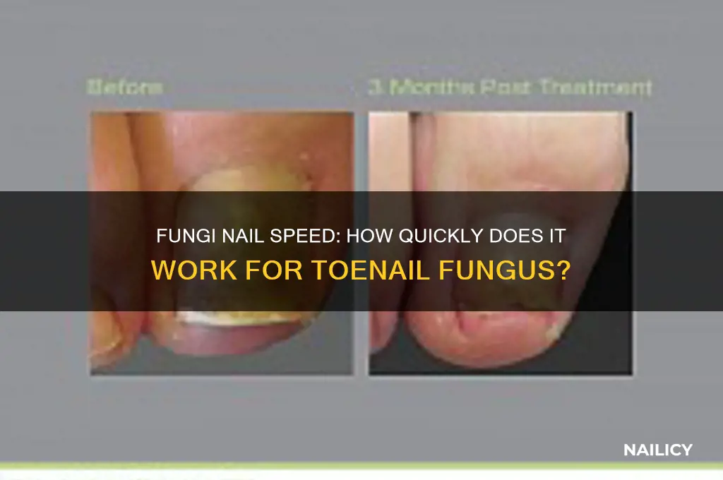 Fungi Nail Speed: How Quickly Does It Work For Toenail Fungus? | Nailicy