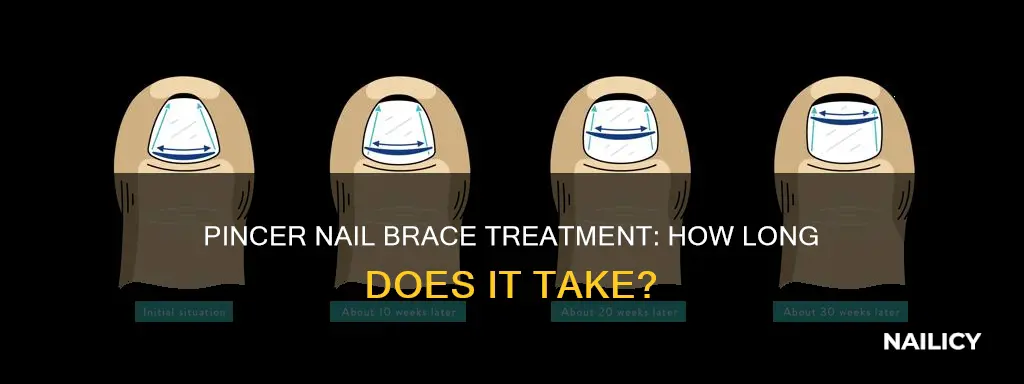 Pincer Nail Brace Treatment: How Long Does It Take? | Nailicy