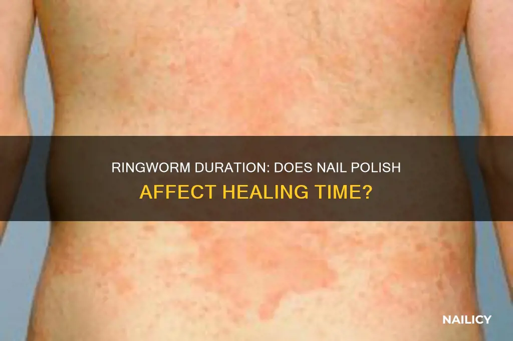 Ringworm Duration: Does Nail Polish Affect Healing Time? | Nailicy
