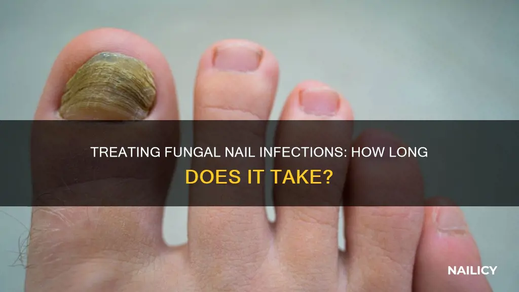 Treating Fungal Nail Infections: How Long Does It Take? | Nailicy