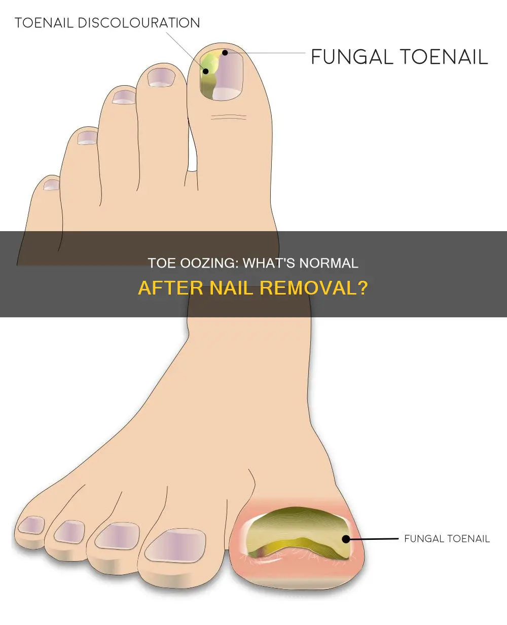 Toe Oozing: What's Normal After Nail Removal? | Nailicy