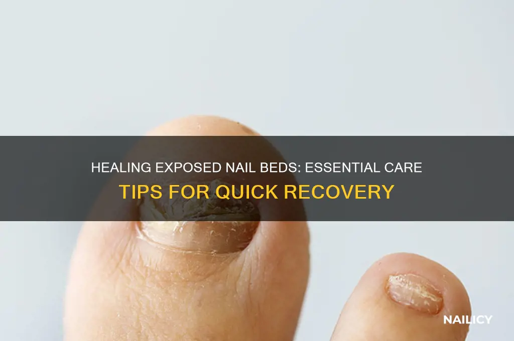 Healing Exposed Nail Beds: Essential Care Tips For Quick Recovery | Nailicy
