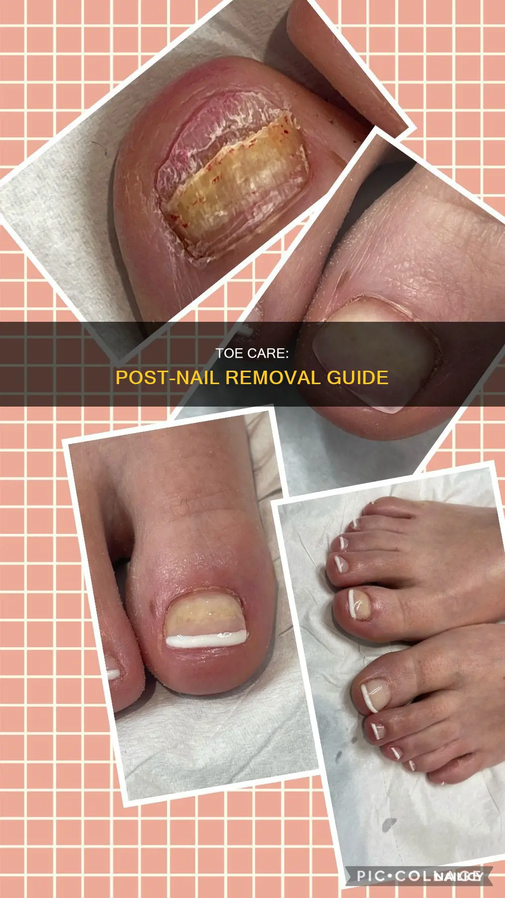 Toe Care: Post-Nail Removal Guide | Nailicy