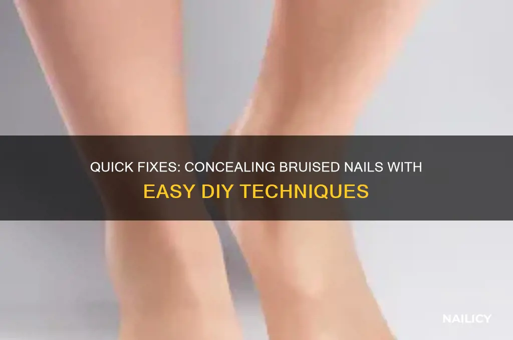 Quick Fixes: Concealing Bruised Nails With Easy Diy Techniques | Nailicy