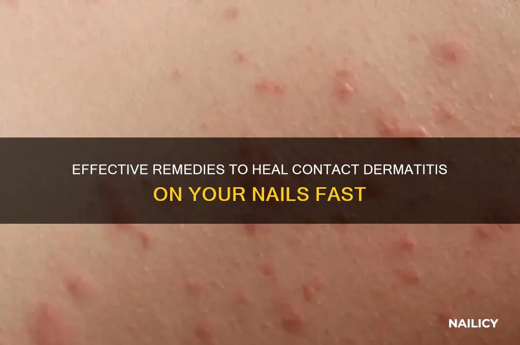 Effective Remedies To Heal Contact Dermatitis On Your Nails Fast | Nailicy