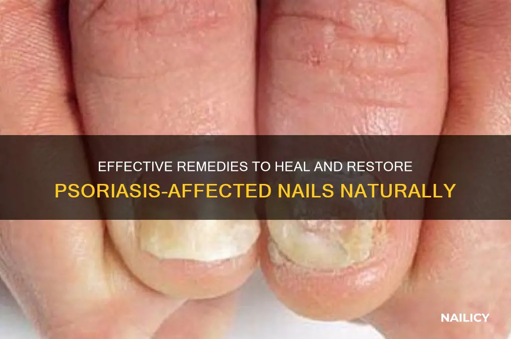 Effective Remedies To Heal And Restore Psoriasis-Affected Nails ...