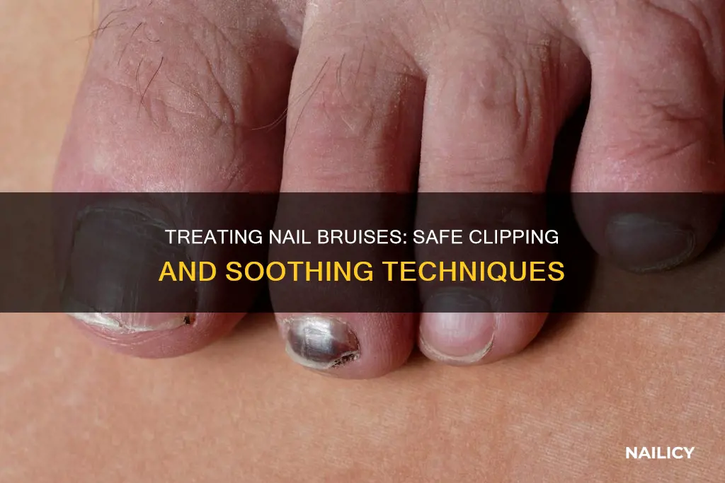 Treating Nail Bruises: Safe Clipping And Soothing Techniques | Nailicy