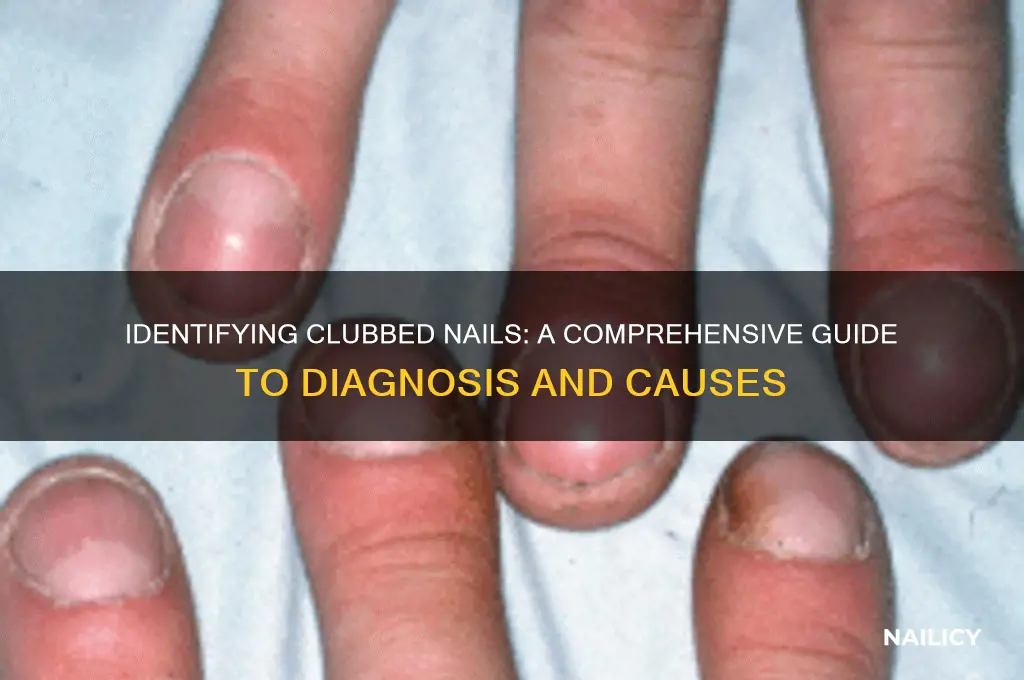 Identifying Clubbed Nails: A Comprehensive Guide To Diagnosis And ...