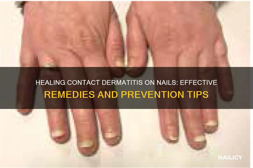 Healing Contact Dermatitis On Nails: Effective Remedies And Prevention ...