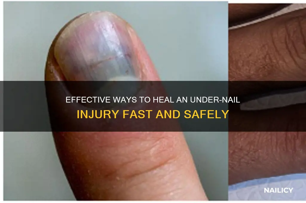 Effective Ways To Heal An Under-Nail Injury Fast And Safely | Nailicy