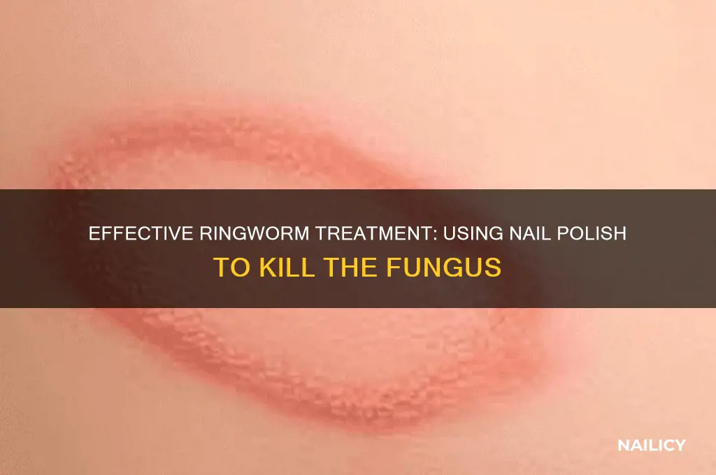 Effective Ringworm Treatment: Using Nail Polish To Kill The Fungus ...